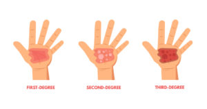 24 Hour Plastic Surgeons for Burn Treatment Long Island NYC